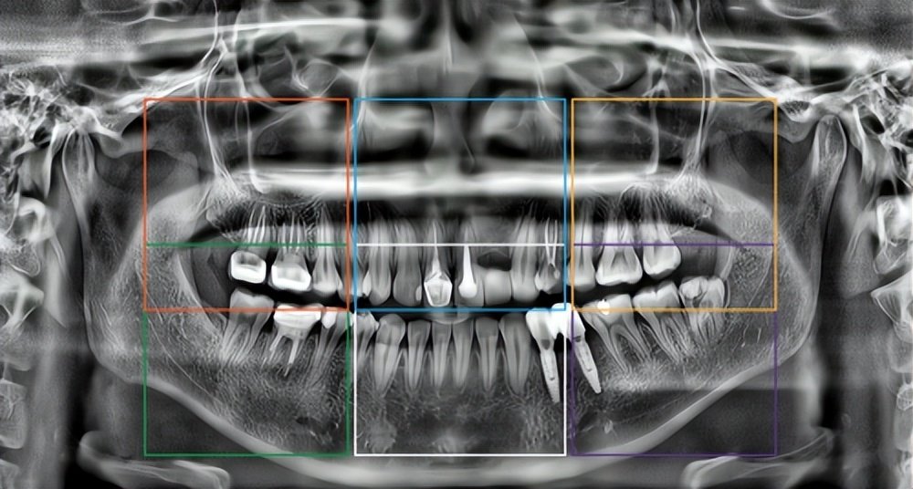 国内首台加持小牙片的口腔CT，博爵五合一CBCT是如何一次性解锁口腔影像全需求的？_凤凰网