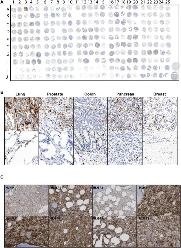 柳叶刀子刊：CD33抗体解除MDSC肿瘤免疫抑制，释放CAR-T治疗实体瘤潜力__凤凰网