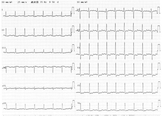 心电在线丨宽窄QRS波心动过速诊断不清？Coumel 定律来帮忙__凤凰网