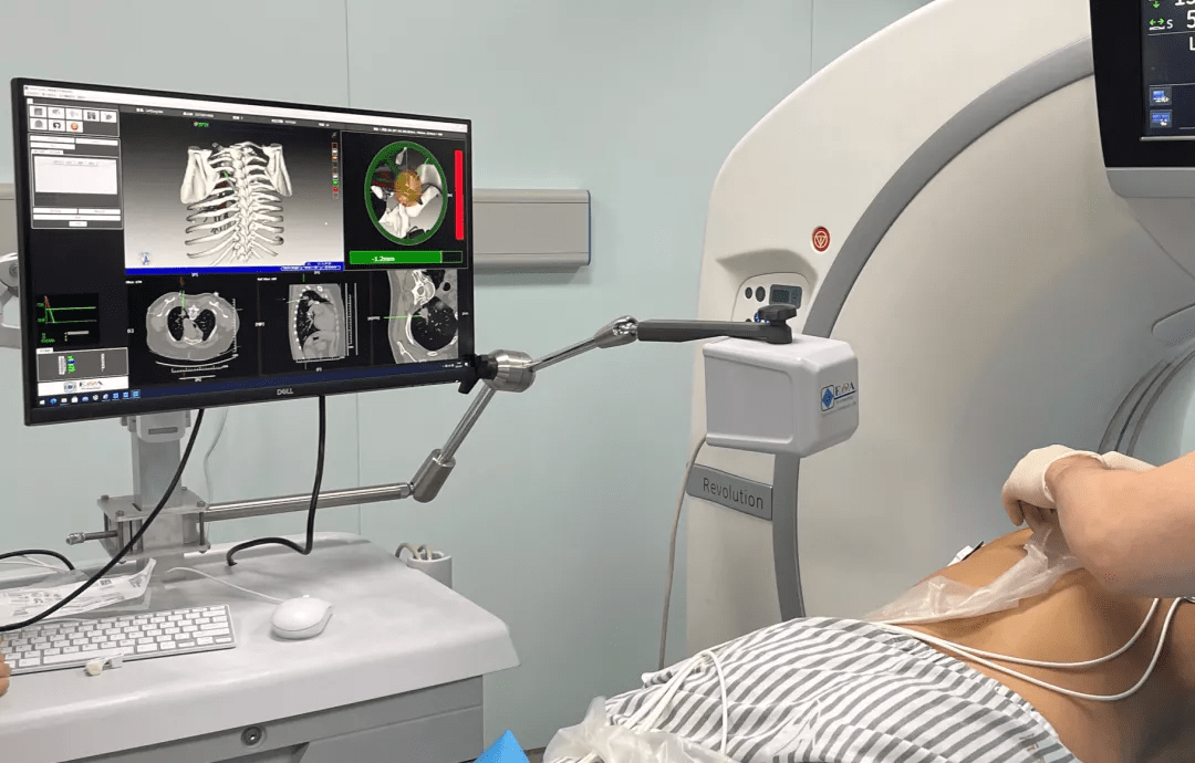 浙大一院智能手术导航机器人引导下肺癌精准穿刺消融手术案例__凤凰网