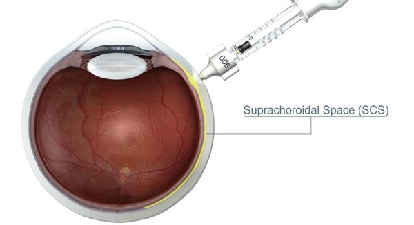 极目生物脉络膜上腔注射疗法III期临床完成患者给药_凤凰网