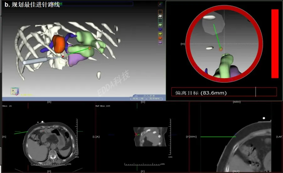 IQQA-Guide穿刺手术导航设备已成功投入三甲医院开展精准诊疗 _凤凰网
