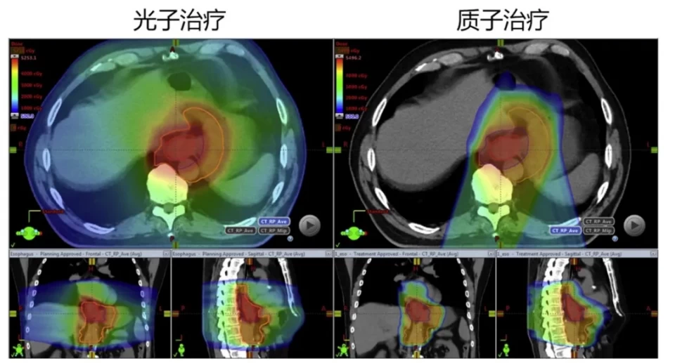 解密食管癌质子治疗的优势 凤凰网