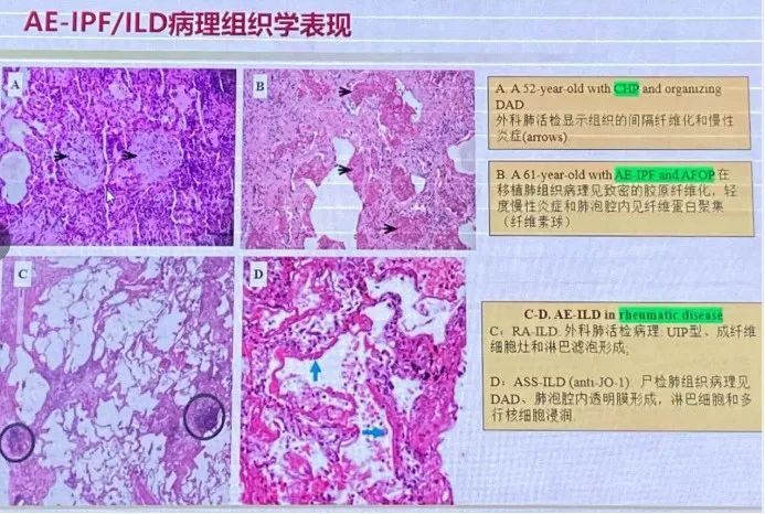 曹孟淑教授：AE-IPF/ILD 诊断和治疗进展_凤凰网健康_凤凰网