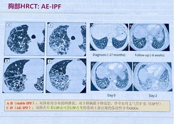 曹孟淑教授：AE-IPF/ILD 诊断和治疗进展_凤凰网健康_凤凰网