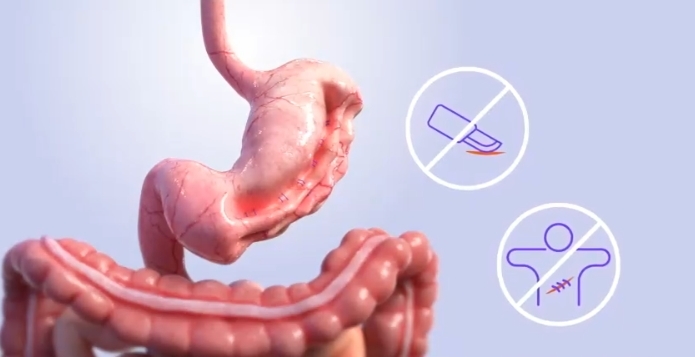 进博Show｜减重黑科技：“缝”起一部分胃，手术可逆_凤凰网