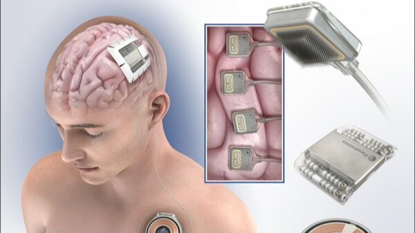 Paradromics即将启动侵入式脑机接口的首次人体临床试验，实现意念控制还会远吗？_凤凰网