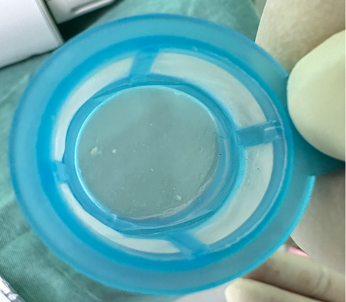 山东首例！市立医院邵一兵教授团队应用SENTINEL抗栓塞脑保护装置行主动脉瓣置换术（TAVR）凤凰网青岛_凤凰网