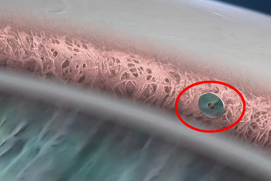 福建省首例！厦门眼科中心成功开展小梁网微支架iStent inject W植入术凤凰网山西_凤凰网