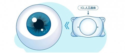 高清视界再“开挂”！新一代V5人工晶体即将登陆爱尔眼科青海一城两院，预约通道已开启！凤凰网海南_凤凰网